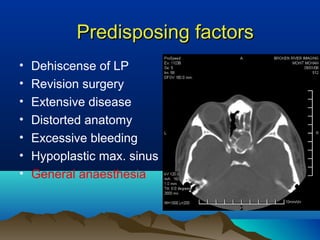 complications fess | PPT