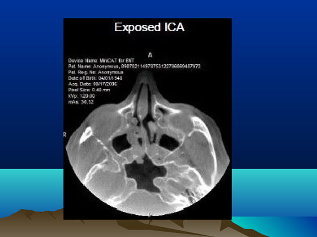complications fess | PPT | Ear, Nose and Throat Conditions | Diseases ...