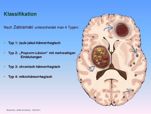 Bildgebung der Kavernome