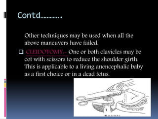 shoulder dystocia | PPTX