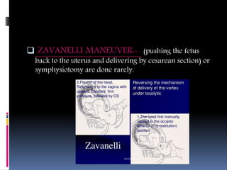 shoulder dystocia | PPTX