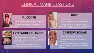Kawadaki disease | PPTX