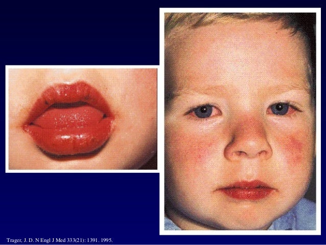 Kawasaki disease