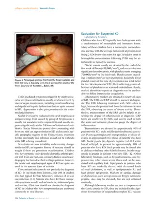 Kawasaki disease | PDF