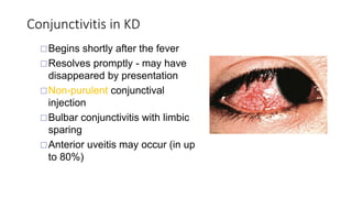 Kawasaki disease | PPTX