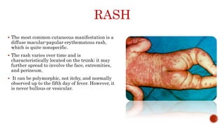 Kawasaki disease | PPTX