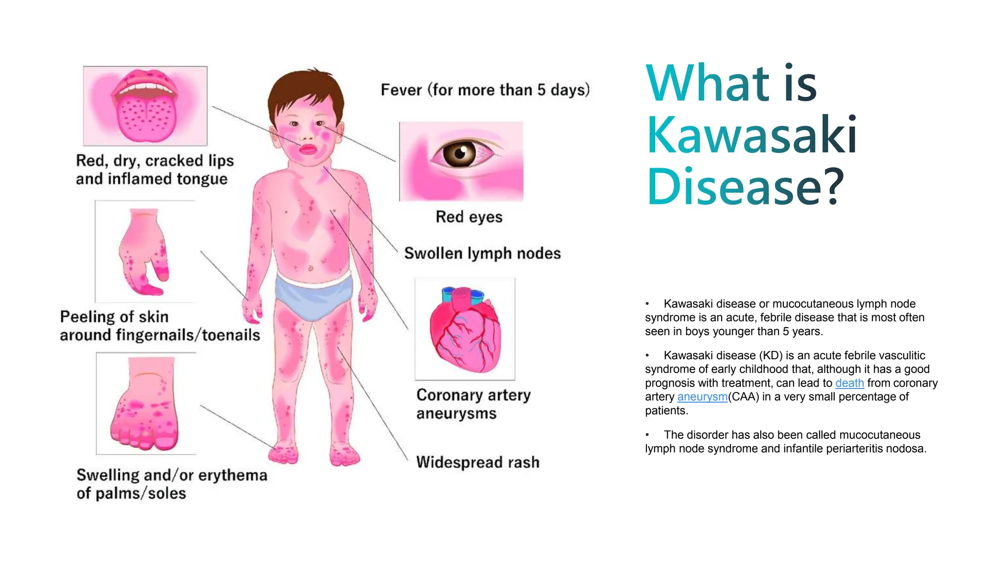 Kawasaki Disease details explain in this , what else to say in forty ...