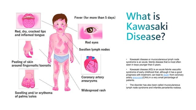 Kawasaki Disease details explain in this , what else to say in forty ...