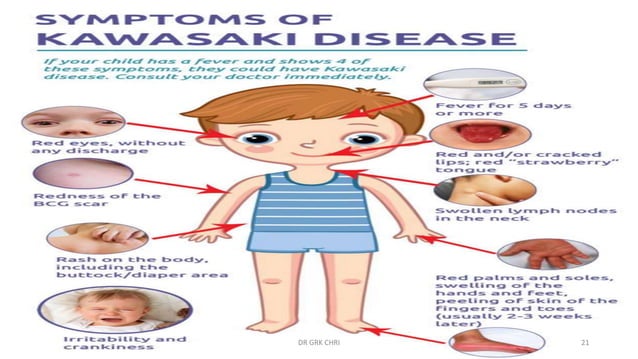 Kawasaki Disease and Henoch-Schonlein purpura in Children.pptx