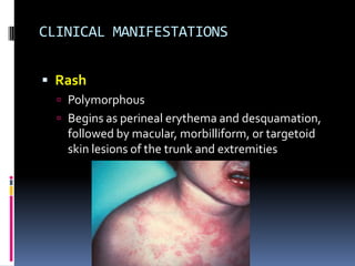 Kawasaki disease by Hassan AL-Qarni | PPT