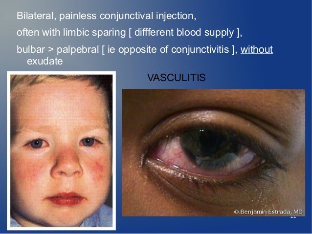 Limbic Sparing Conjunctivitis Diagnosis, Management, And Treatment Of