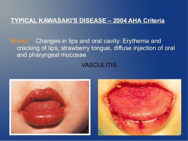 Kawasaki's disease