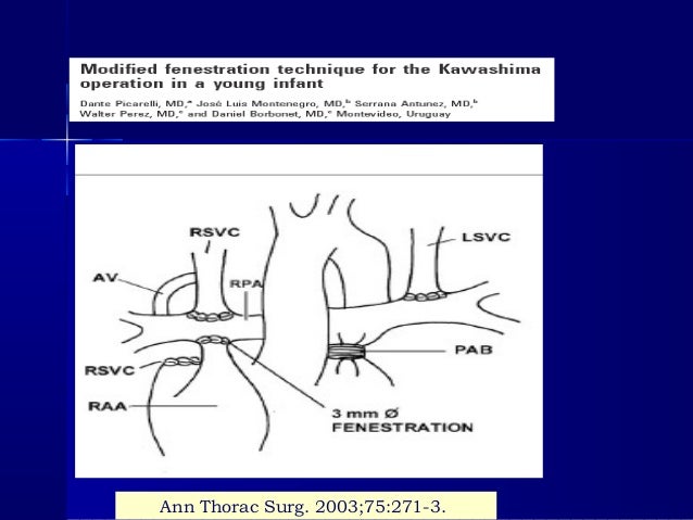 Riskli Bir Kawashima Olgusunda Sol Atrial Appendiks ile Sol Persist…