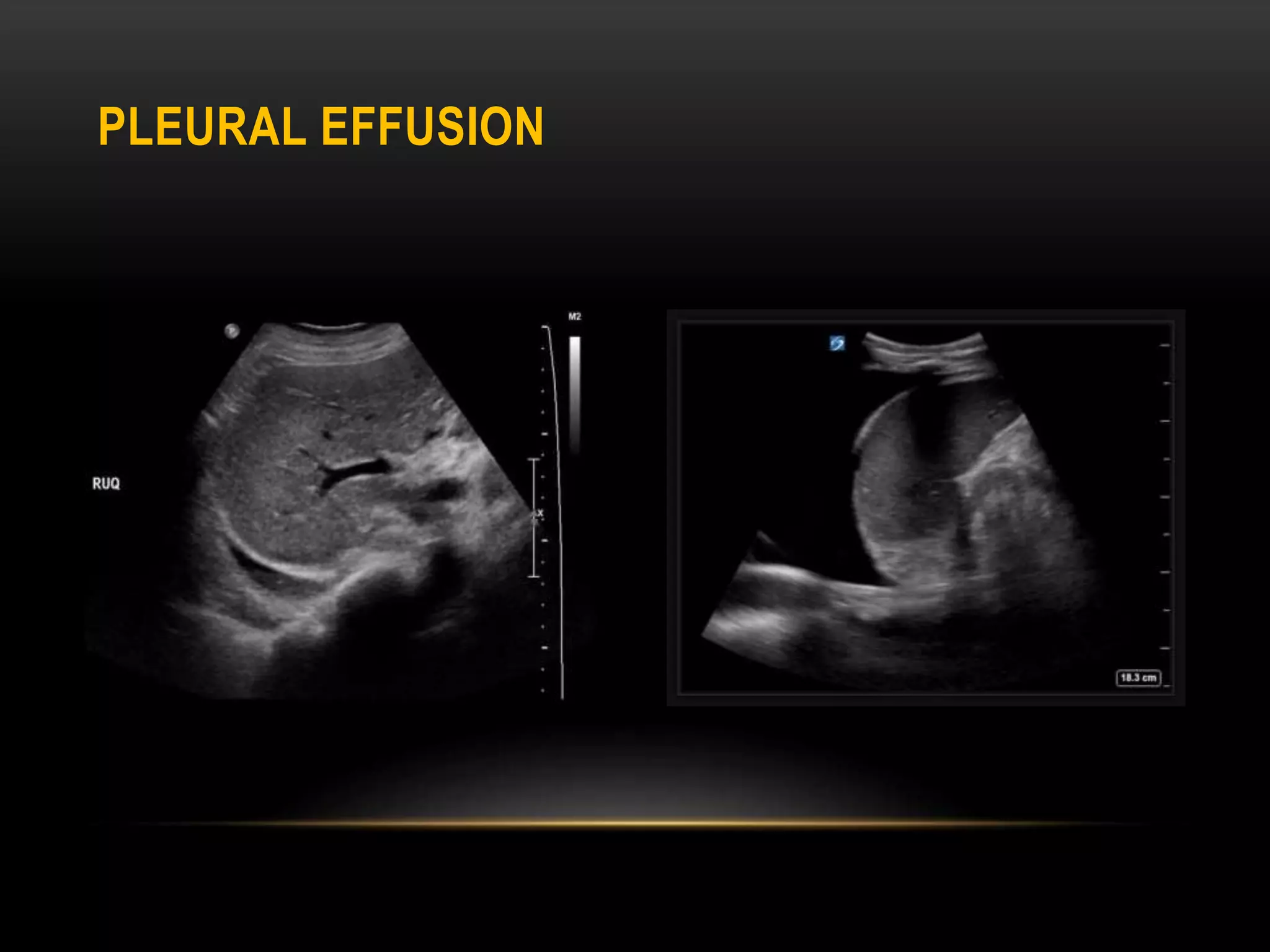 Chest ultrasound.pptx