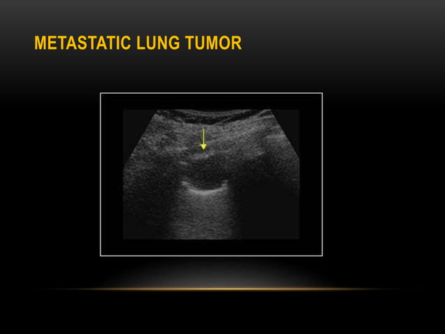 Chest ultrasound.pptx