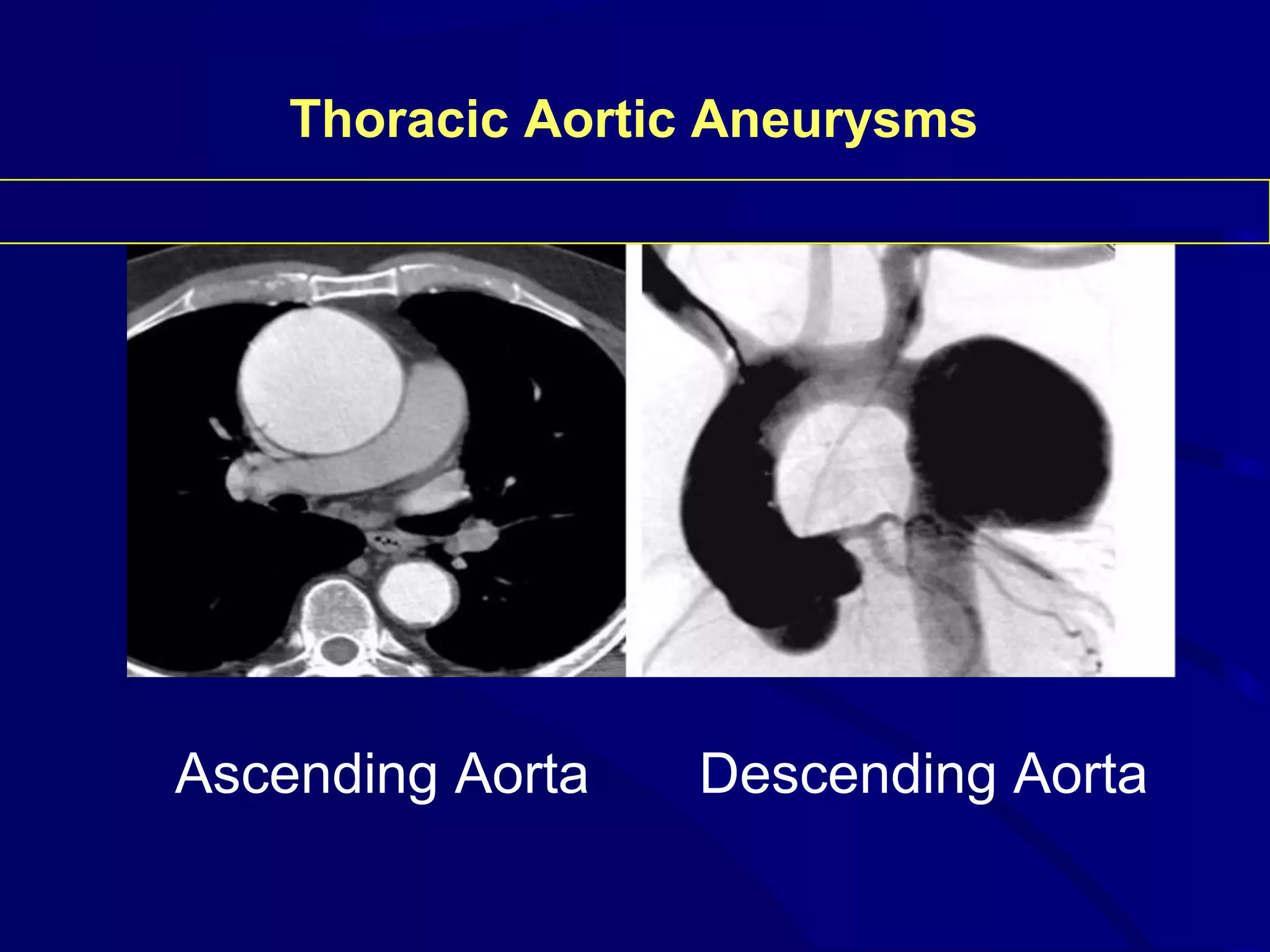 Abdominal Aortic and Thoracic Aneurysms | PPT