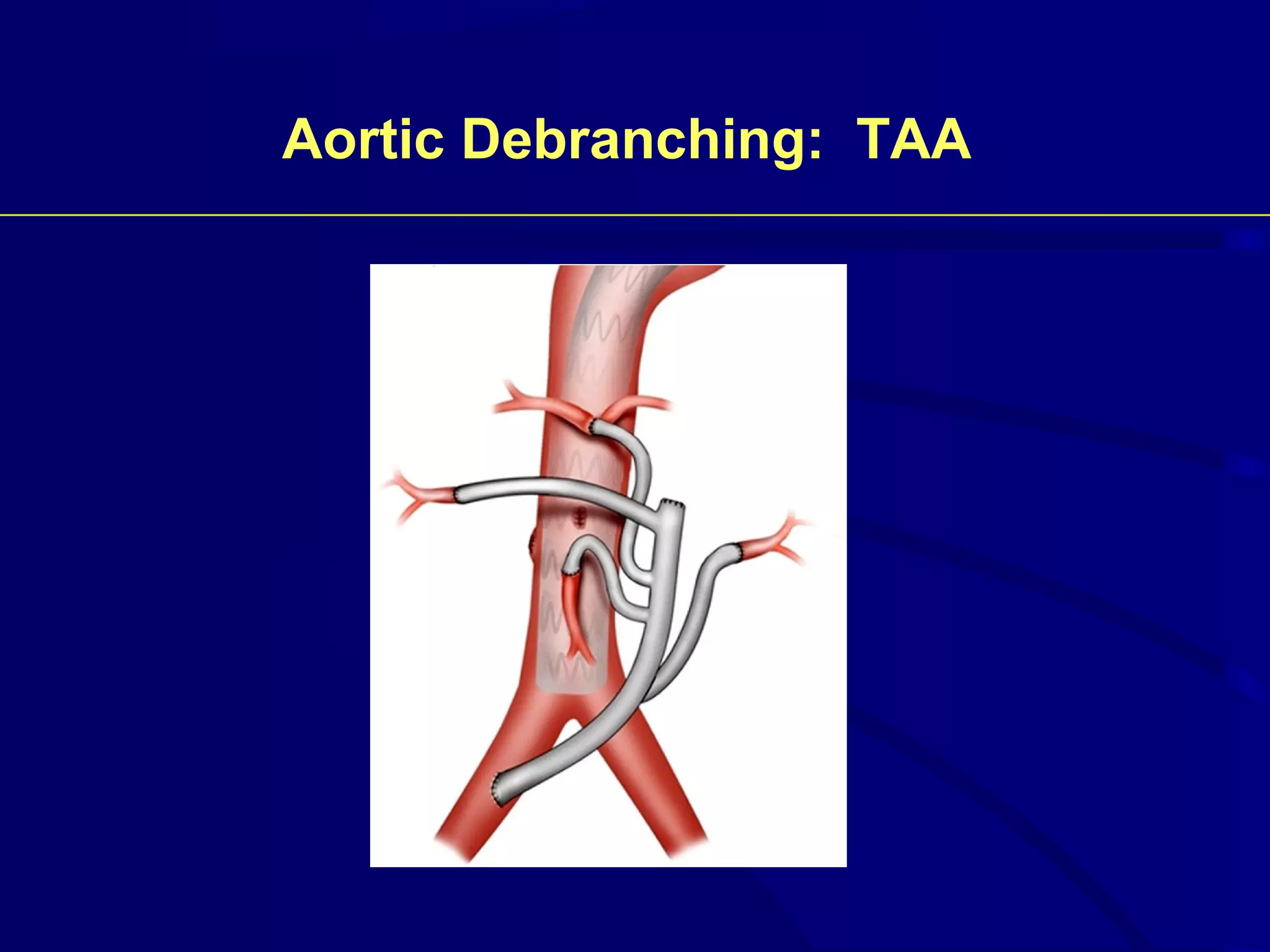 Abdominal Aortic and Thoracic Aneurysms | PPT