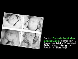 KB 1 Komplikasi Persalinan dan Penatalaksanaannya | PPTX