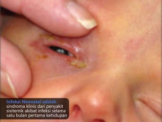 Kb 1 konsep dasar pencegahan infeksi pada neonatus dan bayi | PPTX