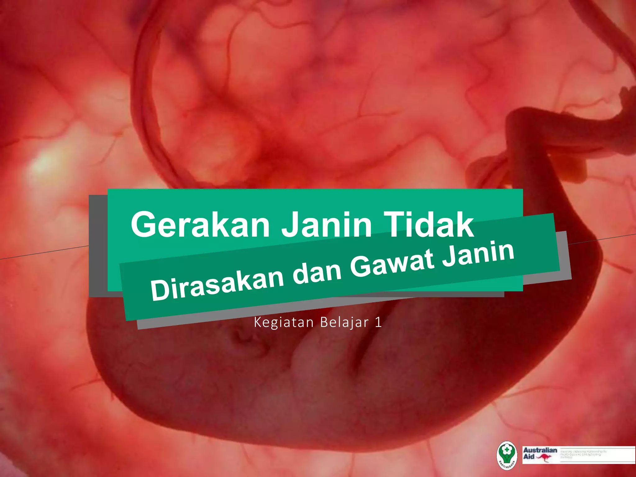 Kb3 gerakan janin tidak dirasakan dan gawat janin | PPTX