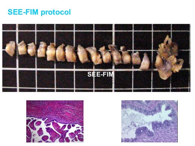 Krishna B Clough : clinical case : SMALL CANCER AND BRCA MUTATION