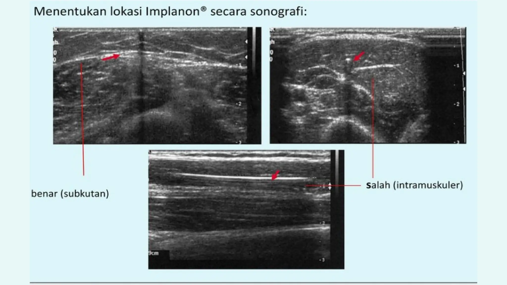 mengenai bermacam-macam jenis KB serta kontraindikasi penggunaan KB | PPTX