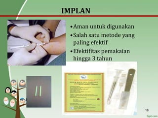 METODE KONTRASEPSI JANGKA PANJANG | PPTX