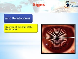 Keratoconus | PPTX