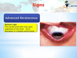 Keratoconus | PPTX