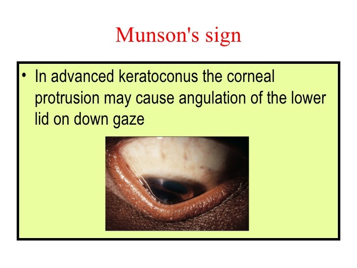 keratoconus