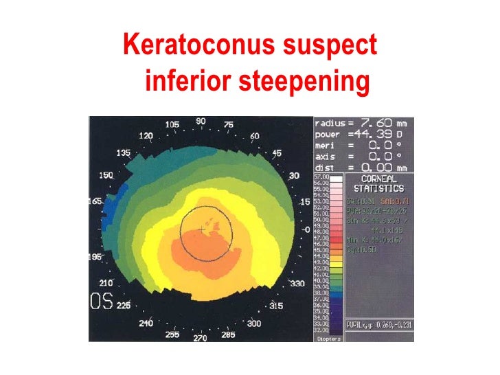keratoconus