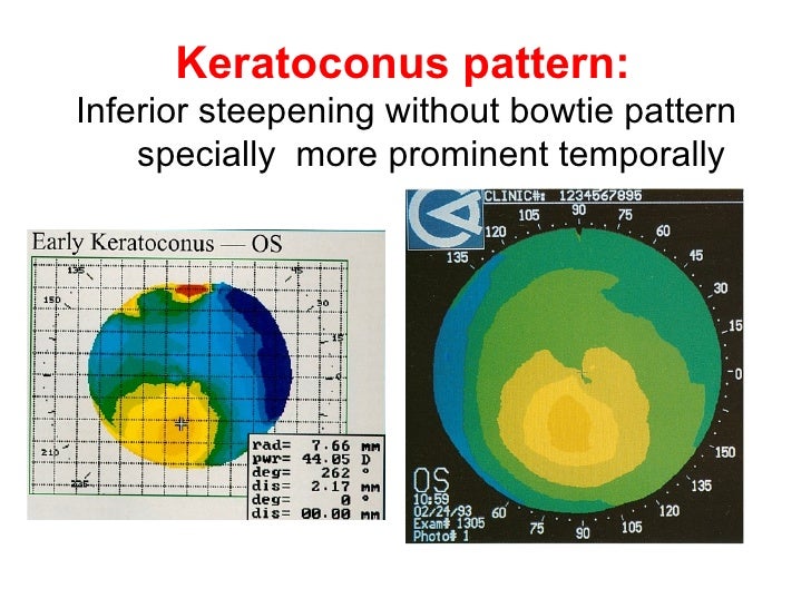 keratoconus