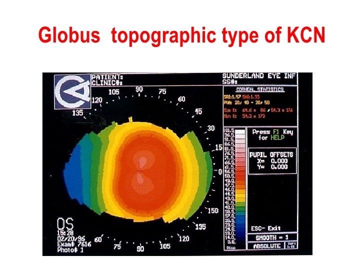 keratoconus