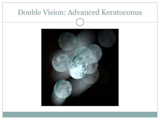 Keratoconus Vision Images