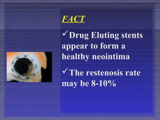 122 drug eluting stents | PPT