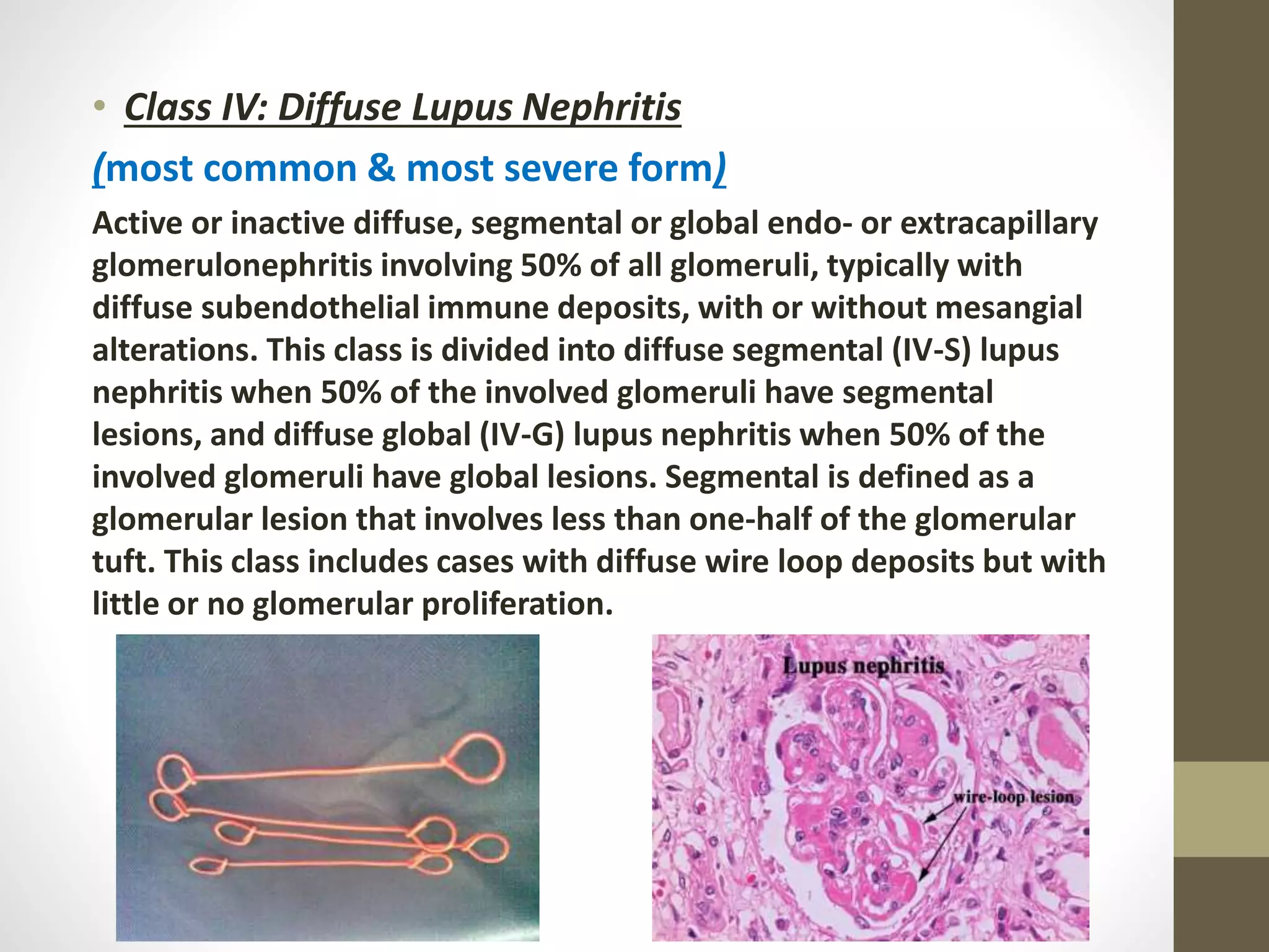 lupus nephritis | PPTX