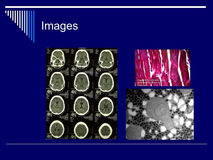 Kearns Sayre Syndrome