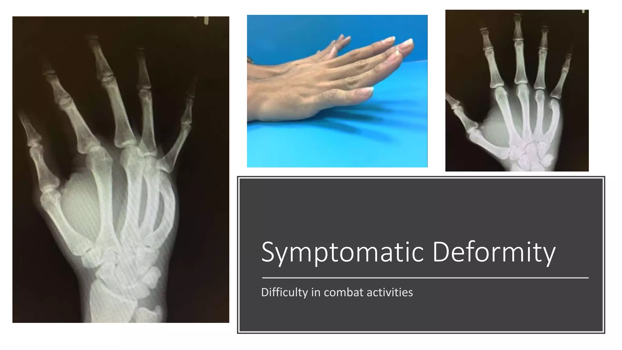 Kebab for hand deformity | PPT