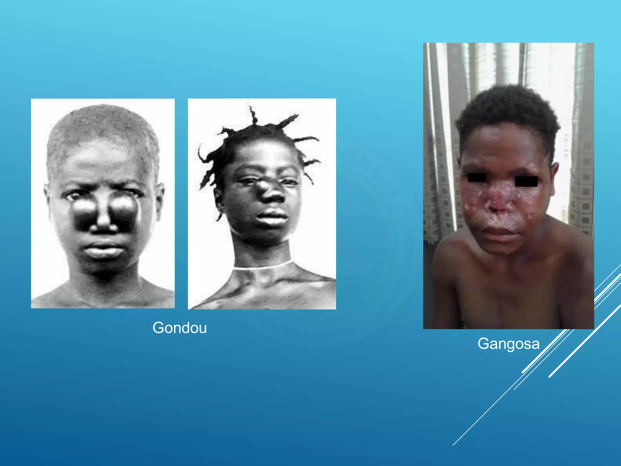 KEBIJAKAN, DIAGNOSA & TATALAKSANA FRAMBUSIA.ppt