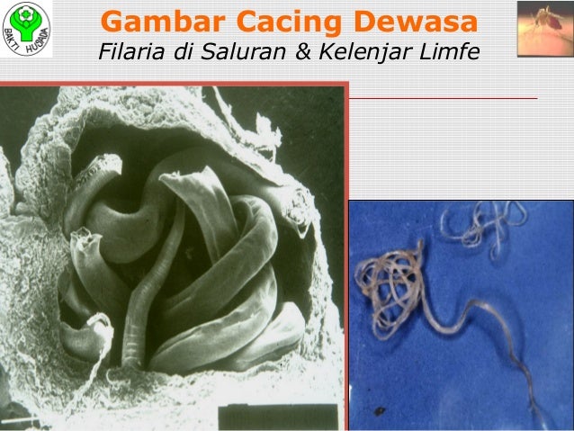 Program Eliminasi Filariasis Di Kabupaten Karawang