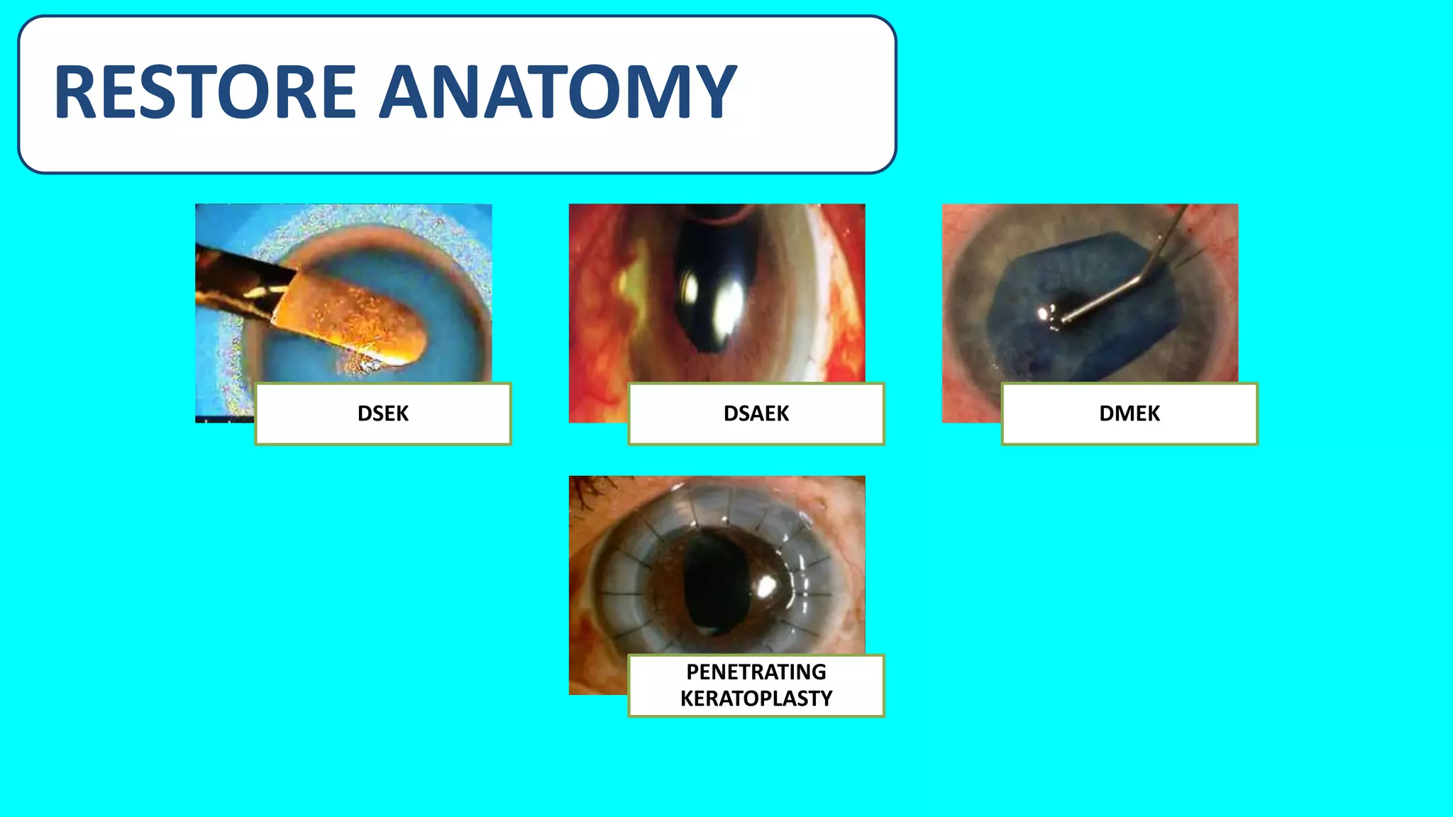 management of post cataract surgery corneal edema | PPTX
