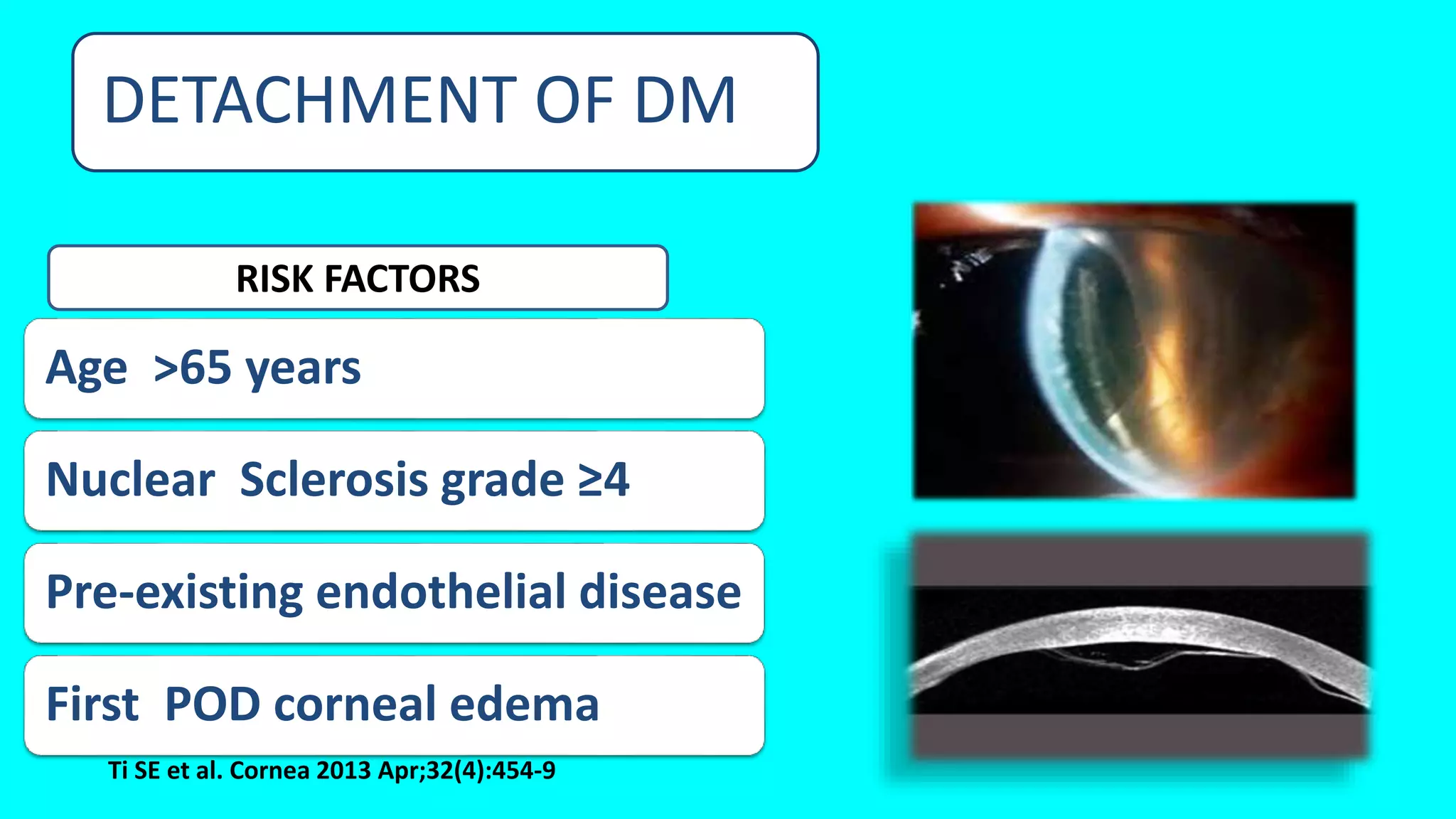 management of post cataract surgery corneal edema | PPTX