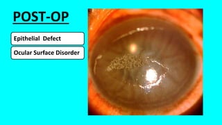 management of post cataract surgery corneal edema | PPTX