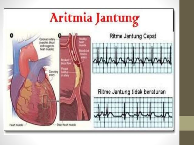 KEGAWATDARURATAN ARITMIA JANTUNG.pptx