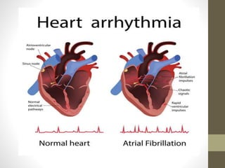 KEGAWATDARURATAN ARITMIA JANTUNG.pptx