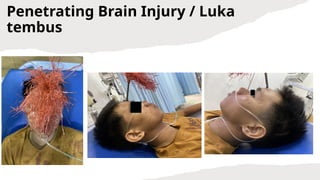 Kegawatdaruratan Neurotrauma Dalam Kehidupan Sehari-hari | PPTX