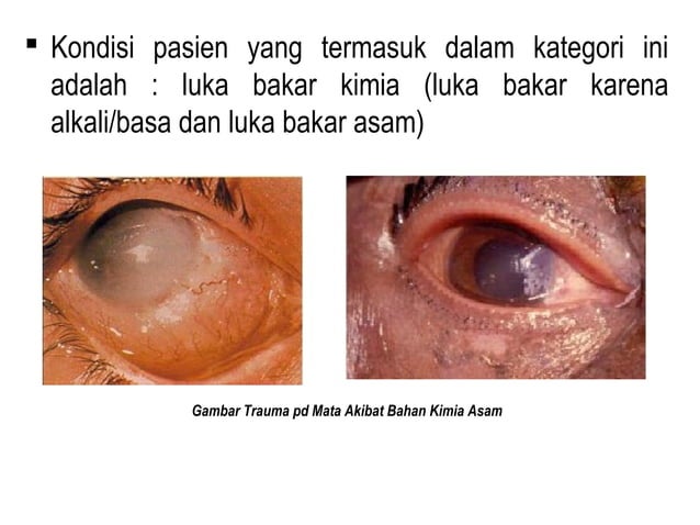 Kegawatdaruratan pada mata | PPT