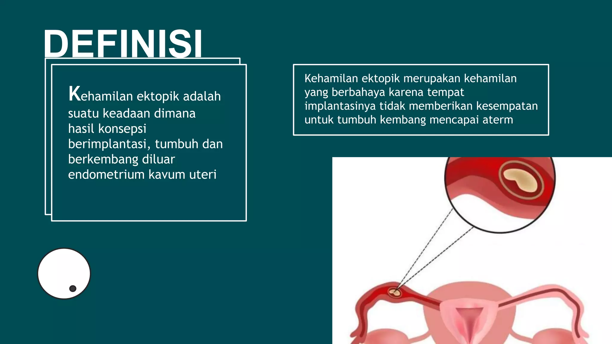 KEHAMILAN EKTOPIK.pptx