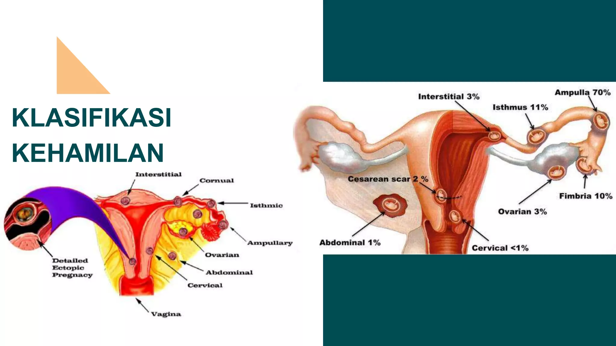 KEHAMILAN EKTOPIK.pptx