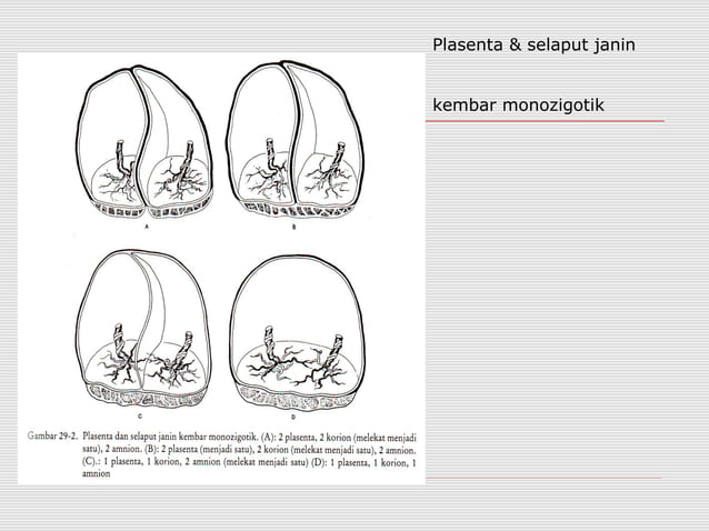 Kehamilan kembar (gemelli) (5) | PPT